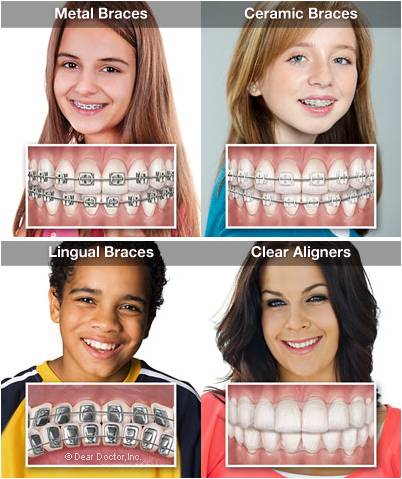 Orthodontic Treatment – Capitol Dental Group | Dr. Michael Johnson | Dr ...